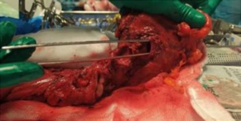 Specimen From Another Perspective Requiring Radical Cystectomy