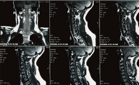 Broken Neck Lady Explained At William Lombard Blog