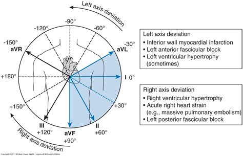 What Causes R Axis Deviation At Donna Champion Blog