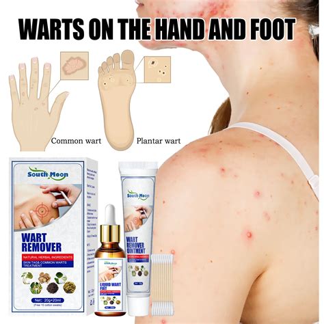 Filiform Wart Removal