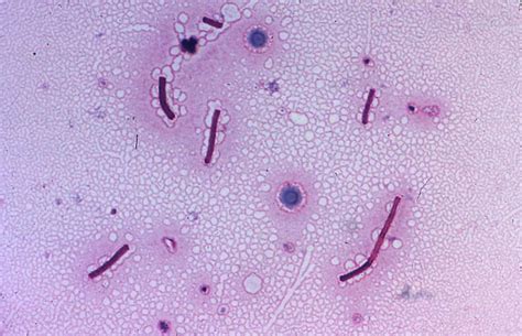 Anthrax Pathology And Ponies