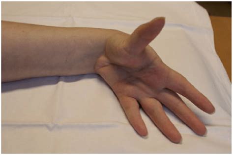 Adduction In Carpometacarpal Joint Of The Thumb And Hyperextension In Download Scientific