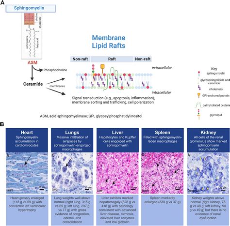 The Impact Of Sphingomyelin On The Pathophysiology And Treatment