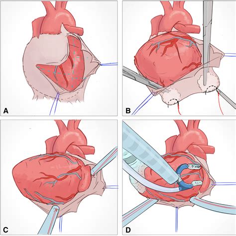 Bypass Operation Schützt Vor Herzinfarkten