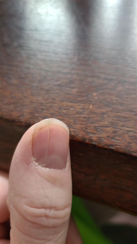 Split Nail R Medical