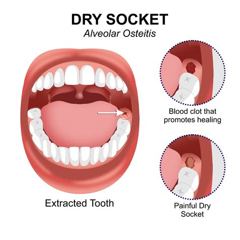 Is Dental Alveolitis Dangerous Dry Socket Explained