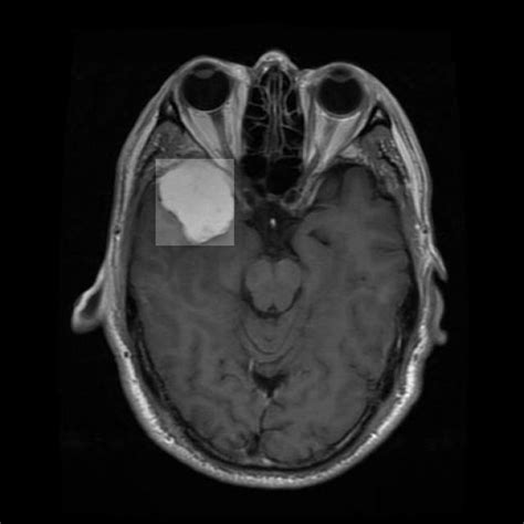 Brain Tumor Object Detection Dataset And Pre Trained Model By Computer