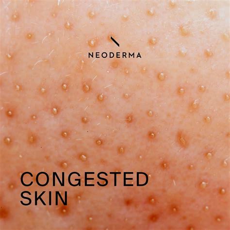 Dehydrated Skin Neoderma Neoderma Medium