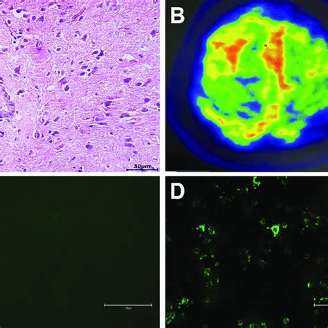 Serum And Csf Markers Before And After Treatment Download Scientific