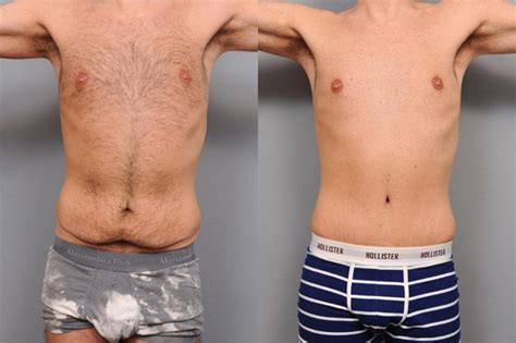 360 Tummy Tuck Green Village Medical