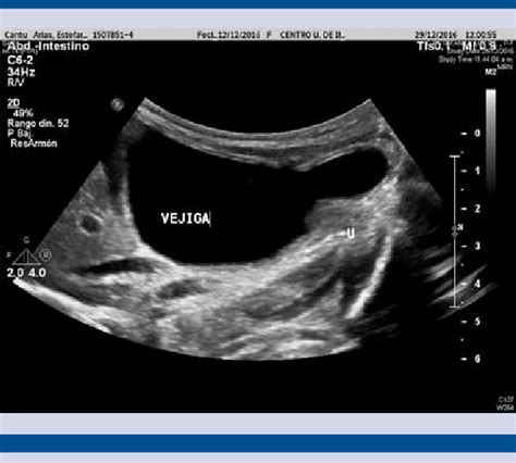 Ultrasonido Abdominal Que Reporta La Vejiga De X X Cm Con Download Scientific
