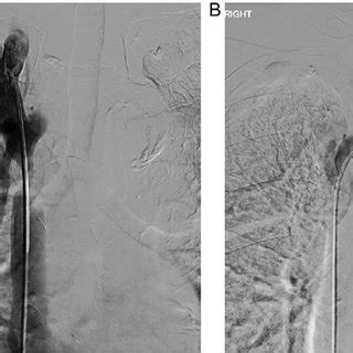 A Left And B Right Venography Demonstrating Flow Limiting High