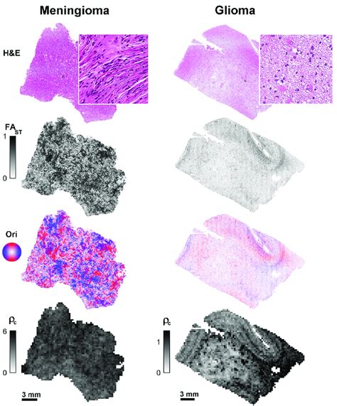 Quantitative Microscopic Analysis Of Tumor Tissue The Top Row Shows