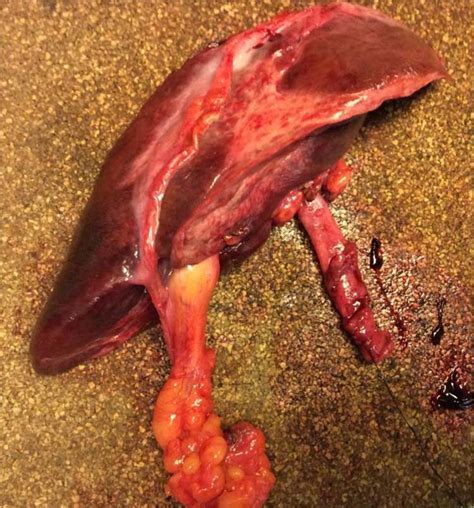 Specimen Left Hemi Hepatectomy And The Resected Acbd Download Scientific Diagram