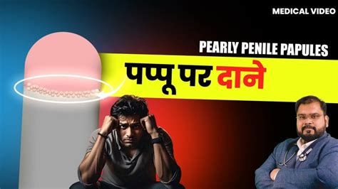 Pearly Penile Papules Ppp Causes Symptoms And The Best Treatment