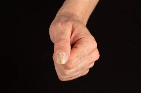 Ketahui 6 Penyebab Terjadinya Onychogryphosis