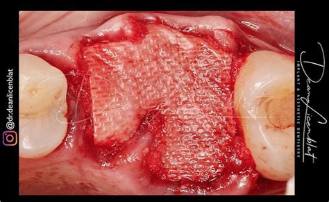 Atraumatic Extractions By Tooth Sectioning Morning Huddle