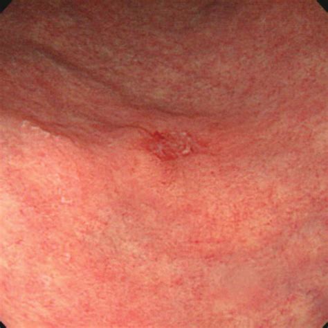 Eus Guided Rendezvous Ercp For Pancreatic Stone Removal A Download Scientific Diagram