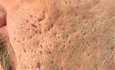 Ice Pick Acne Scar
