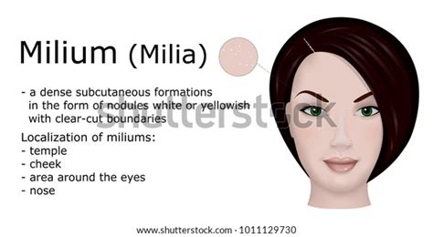 Milia Stock Vectors Images Vector Art Shutterstock