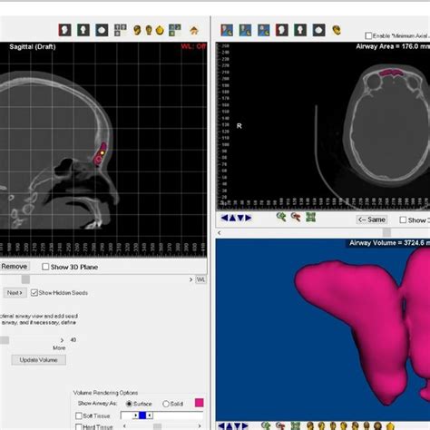 example of 3d segmentation through dolphin software visualization of