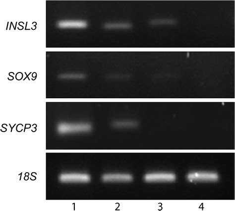 Association Of Aberrant Expression Of Sex Determining Gene Fibroblast
