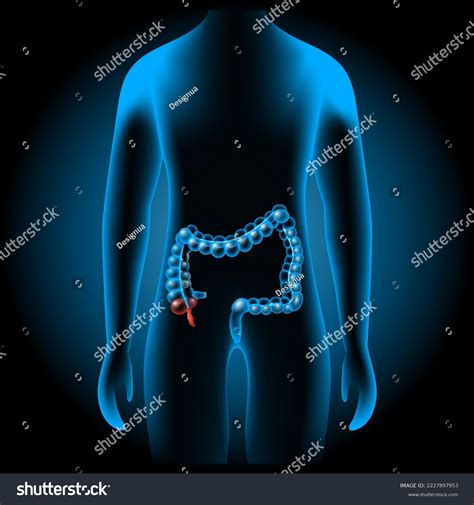Appendicitis Inflammation Appendix Red Vermix Part Stock Vector Royalty Free 2227897953
