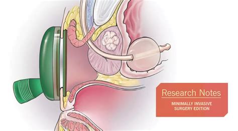 Radical Prostatectomy
