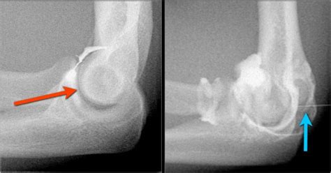 The Radiology Assistant Mri Examination Of The Elbow