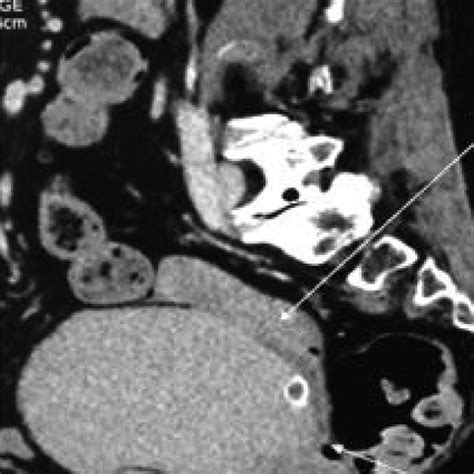 Sagittal Ct Scan Showing Circumferential And Heterogeneous Urethral
