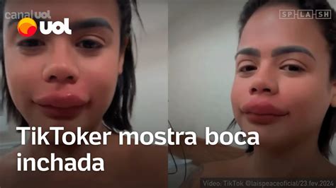 Influencer Impressiona Ao Mostrar Boca Inchada E Chora Com