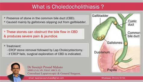 Choledocholithiasis An Overview