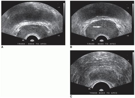 The Prostate Gland Radiology Key