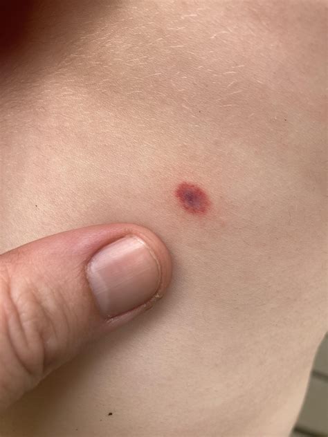 Daughter Got Bit By A Tick Does This Look Like A Bullseye Rash Rlyme