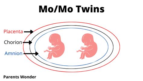 Mo Di Twins Explained Gestation Risks Delivery And More