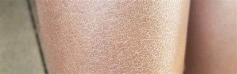 Epilyt Lotion For Dry Skin Canada Drugs Direct