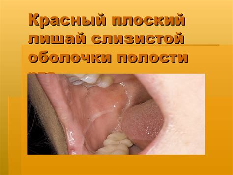 Красный плоский лишай слизистой оболочки полости рта презентация онлайн