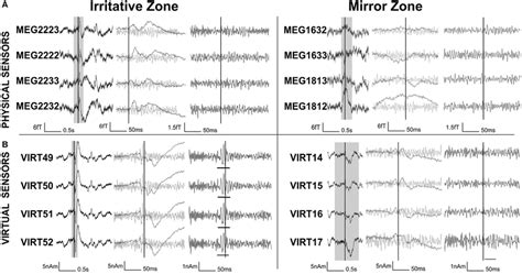 High Frequency Oscillations Hfos On Physical Magnetoencephalography Download Scientific