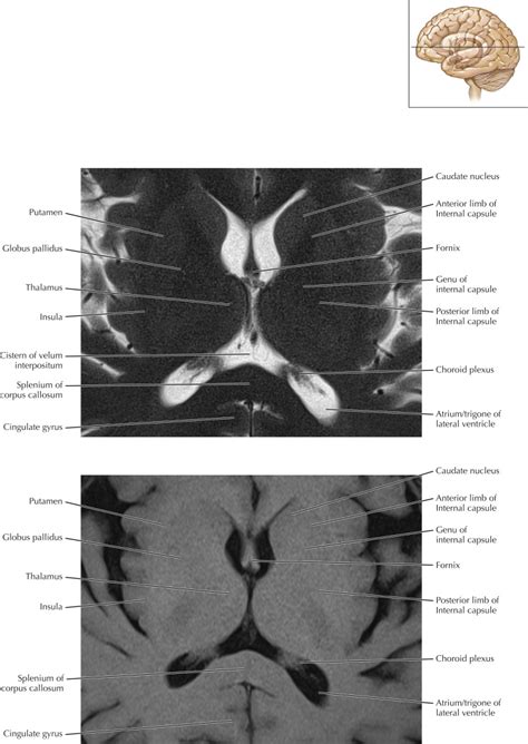 Limbic System Anatomy Mri
