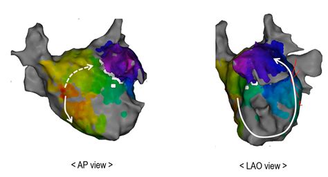 Atypical Form Of Biatrial Tachycardia Using An Interatrial Connection In The Superior Septum