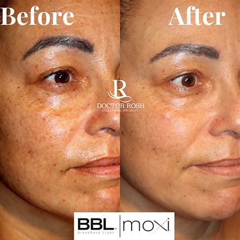 Bbl Light Treatment Before And After At Sebastian Lyne Blog