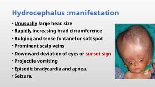 Comprehensive Overview Of Cns Congenital Anomalies And Neural Tube