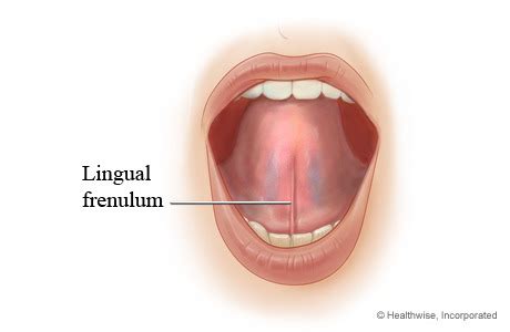 Lingual Frenulum Bump