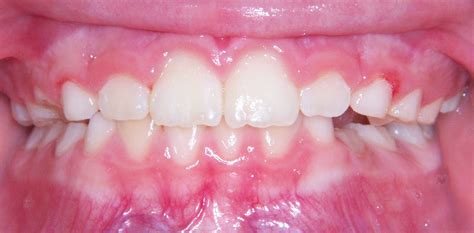 Dental Functional Shift At Susan Tucker Blog