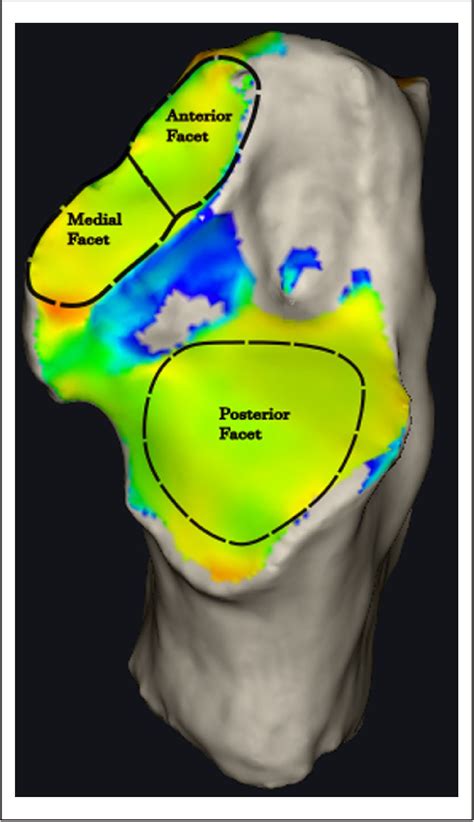 Figure 1 From Classification Of The Os Calcis Subtalar Morphology In Symptomatic Flexible