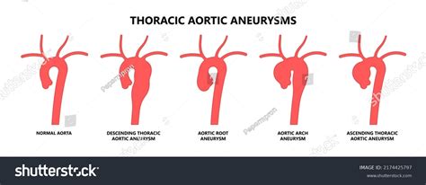 Anévrisme Aortique Thoracique Classification De Lanatomie Image