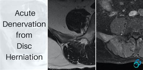 Mri Lumbar Disc Herniation And Acute Denervation Radedasia