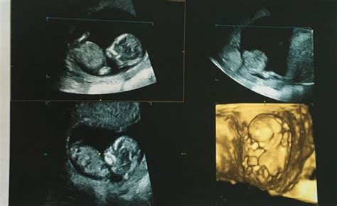 C Est Possible De Faire Une Erreure Sur Le Sexe Du Bebe A 17 Sa 6 Novembre 2016 BabyCenter