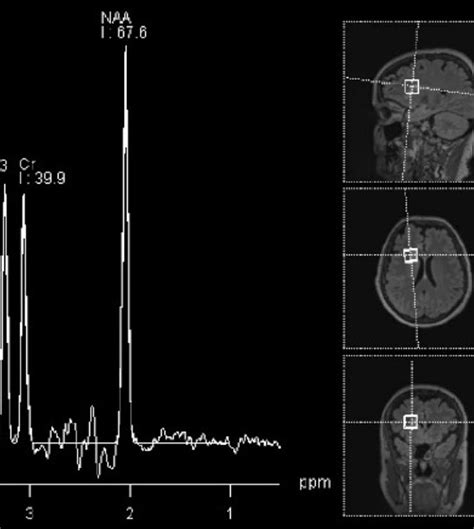 Exploring Glioblastoma Detection With Artificial Intelligence Naxon