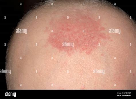 Birthmark On The Scalp Of A 6 Month Old Boy This Is A Type Of